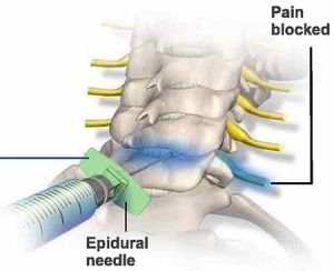 Caudal Epidural Steroid Injections | Back Pain Specialists in Brooklyn