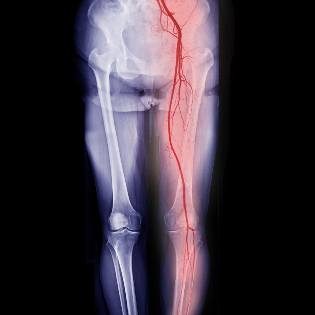 Anatomía Del Nervio Cutáneo Femoral Lateral Nervio Femoral: